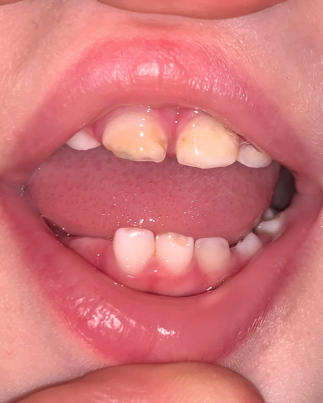 How to Remineralize Teeth Naturally | Enamel Hypoplasia | Raising ...