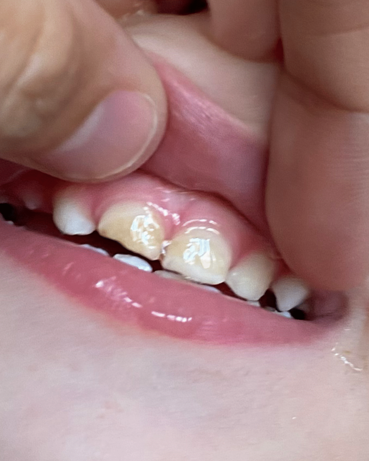 How to Remineralize Teeth Naturally | Enamel Hypoplasia | Raising ...